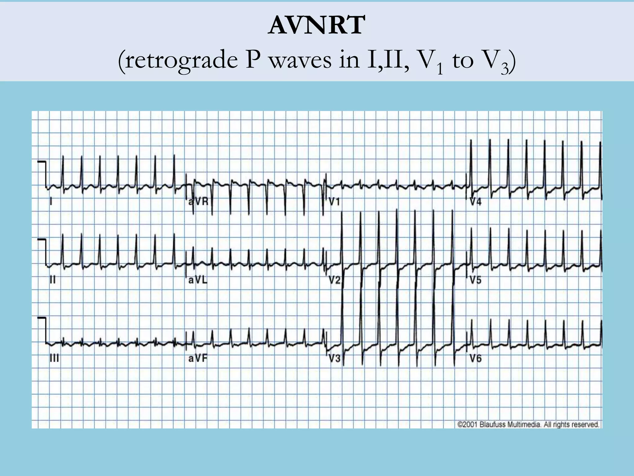 Lec 9 narrow complex wide complex tachycardia for mohs | PPTX | Heart ...