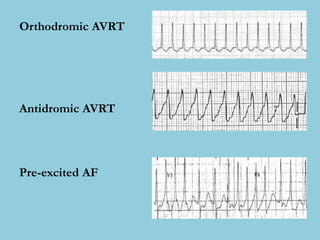 Lec 9 narrow complex wide complex tachycardia for mohs | PPTX