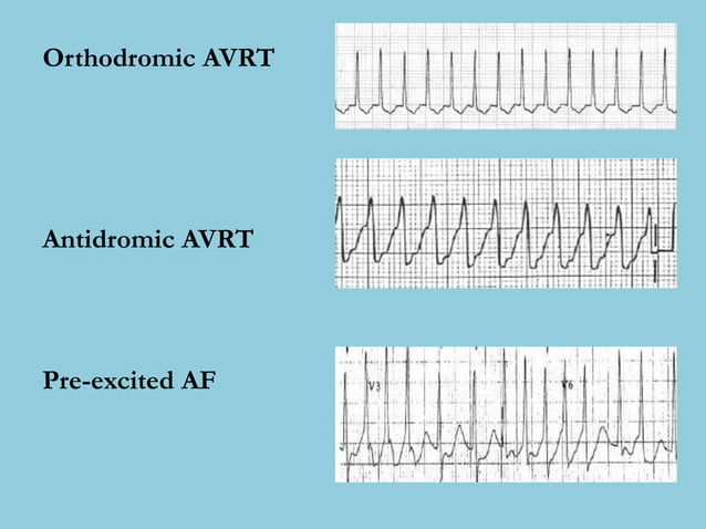 Lec 9 narrow complex wide complex tachycardia for mohs | PPTX | Heart ...