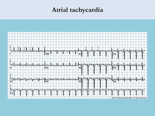 Lec 9 narrow complex wide complex tachycardia for mohs | PPT