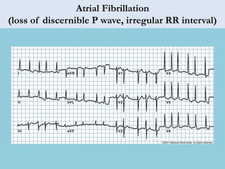 Lec 9 narrow complex wide complex tachycardia for mohs | PPT