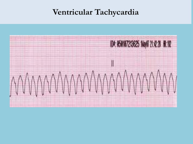 Lec 9 narrow complex wide complex tachycardia for mohs | PPTX | Heart ...