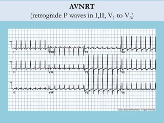 Lec 9 narrow complex wide complex tachycardia for mohs | PPTX
