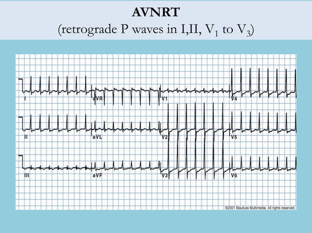 Lec 9 narrow complex wide complex tachycardia for mohs | PPTX | Heart ...