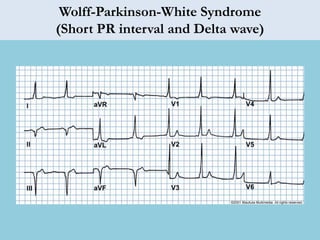 Lec 9 narrow complex wide complex tachycardia for mohs | PPT