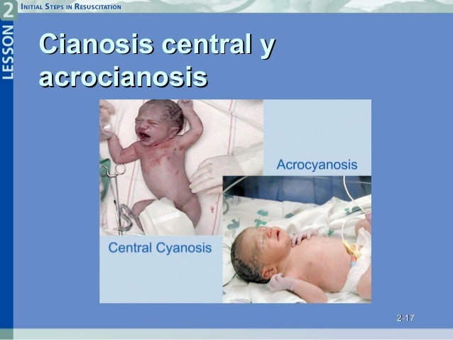 Lección 2 Reanimación Neonatal 6ta edición