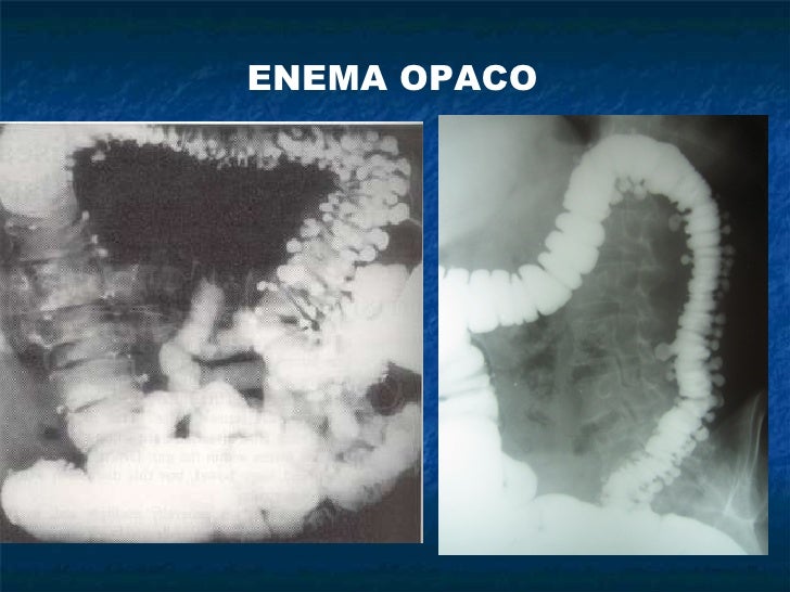 Enema Opaco
