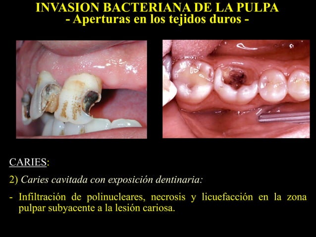 Etiopatogenia del complejo pulpo-periapical.pdf