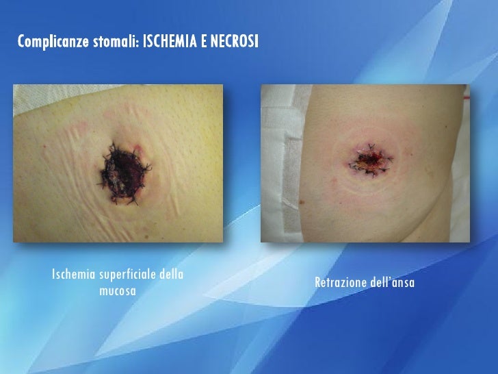 Le complicanze stomali e peristomali precoci e tardive - Corso Stomat…