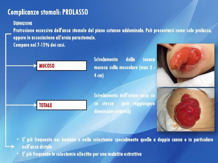 Le complicanze stomali e peristomali precoci e tardive - Corso Stomat…