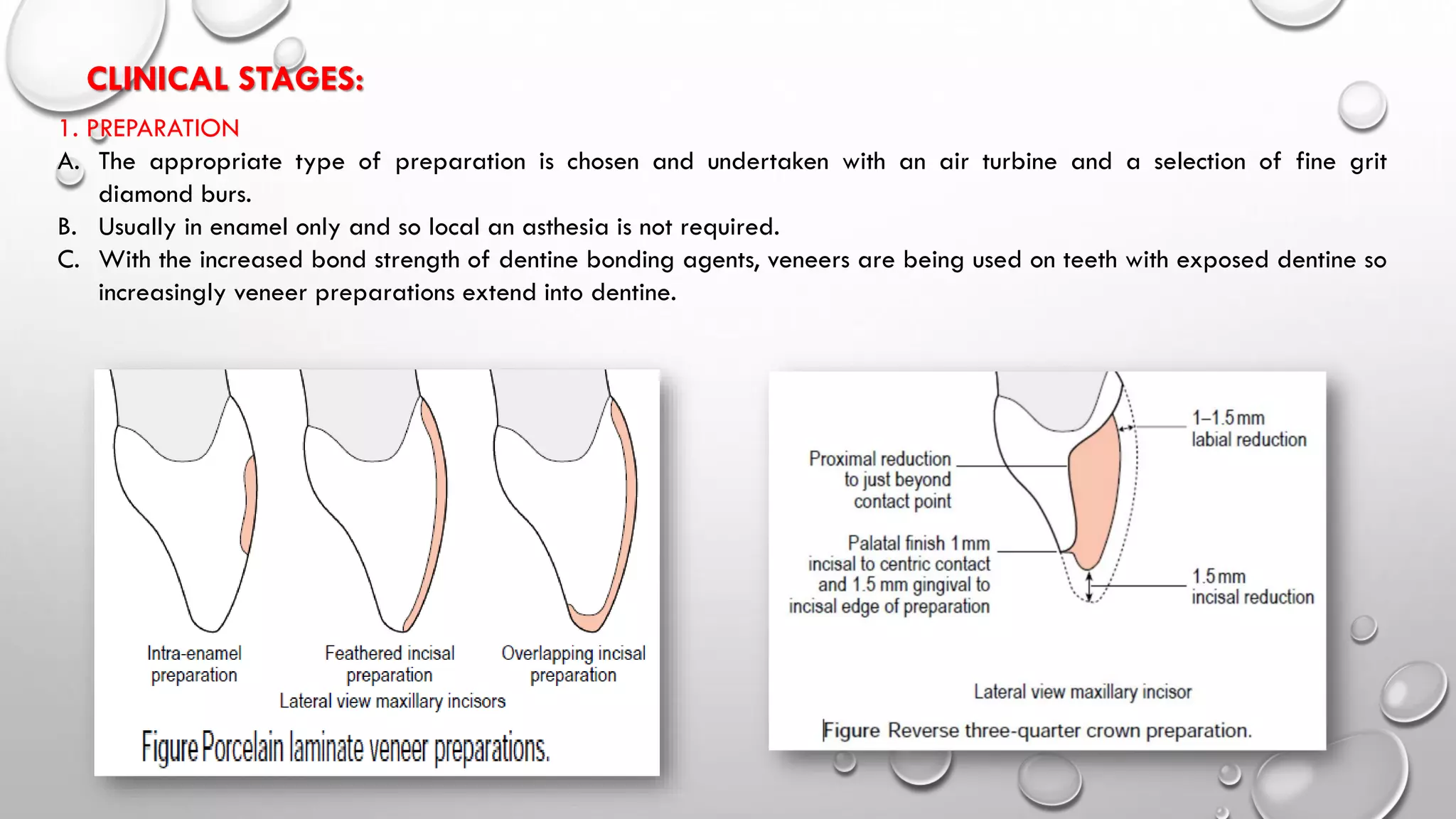 Lect.6 indirect esthetic adhesive restorations | PDF