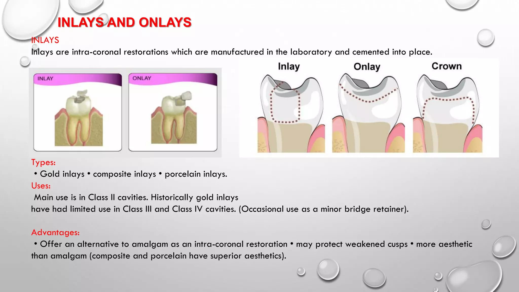 Lect.6 indirect esthetic adhesive restorations | PDF
