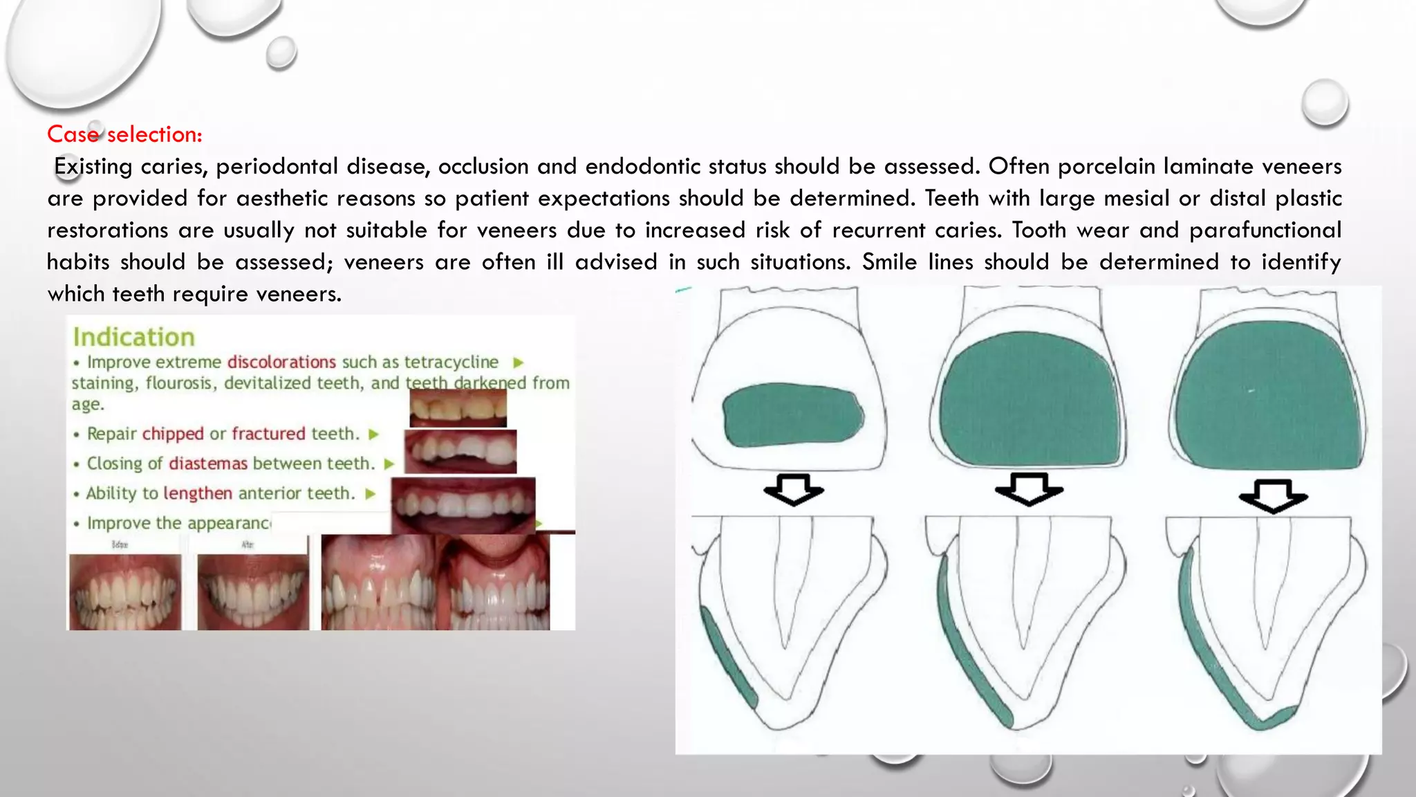 Lect.6 indirect esthetic adhesive restorations | PDF