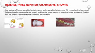Lect.6 indirect esthetic adhesive restorations | PDF