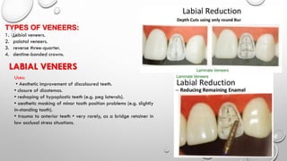 Lect.6 indirect esthetic adhesive restorations | PDF