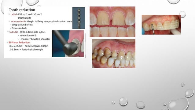 Lect.6 indirect esthetic adhesive restorations | PDF