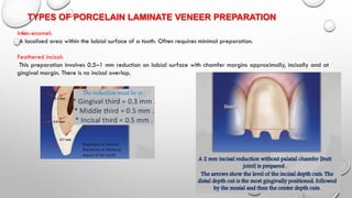 Lect.6 indirect esthetic adhesive restorations | PDF