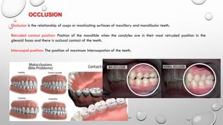 Lect.7. Tooth bleaching and occlusion | PPT