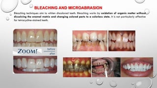 Lect.7. Tooth bleaching and occlusion | PDF