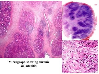 Lect.2. salivary gland pathology | PPT