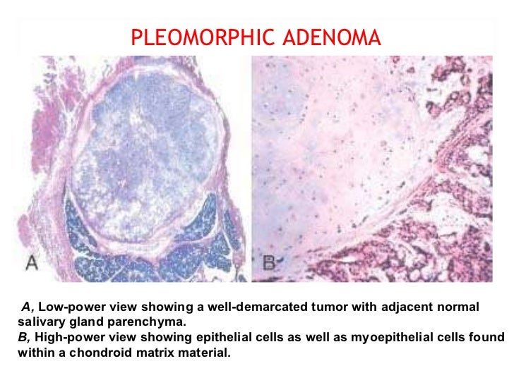 Lect.2. salivary gland pathology