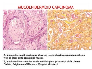 Lect.2. salivary gland pathology | PPT