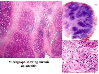 Lect.2. salivary gland pathology | PPT
