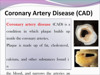 Lect 2 angina | PPT