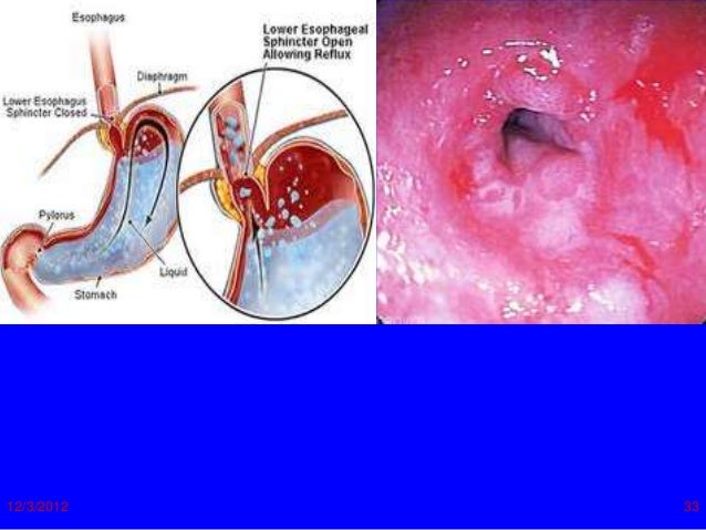 Lect.3.diseases of esophagus
