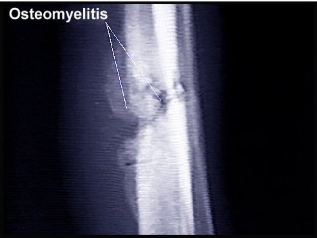 Osteomyelitis | PPT | Bone and Joint Conditions | Diseases and Conditions