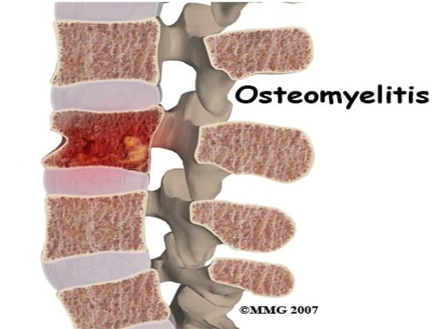 Osteomyelitis | PPT | Bone and Joint Conditions | Diseases and Conditions
