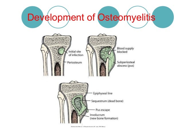 Osteomyelitis