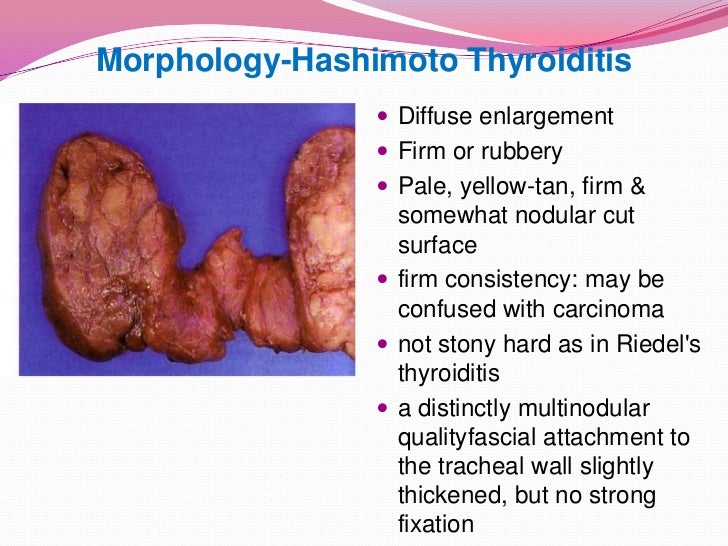Lect 3-thyroid disorders