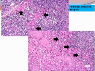 Thyroid disorders | PPT