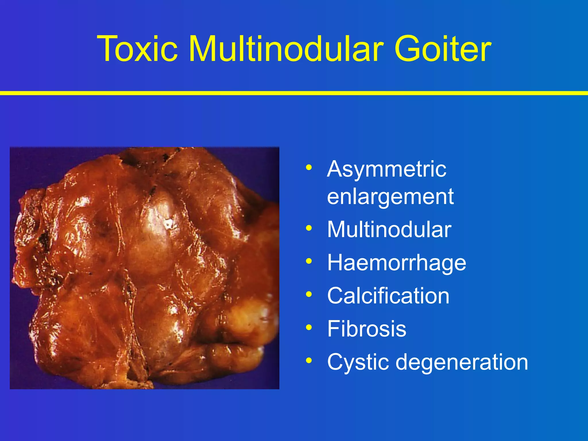 Goiter | PPT