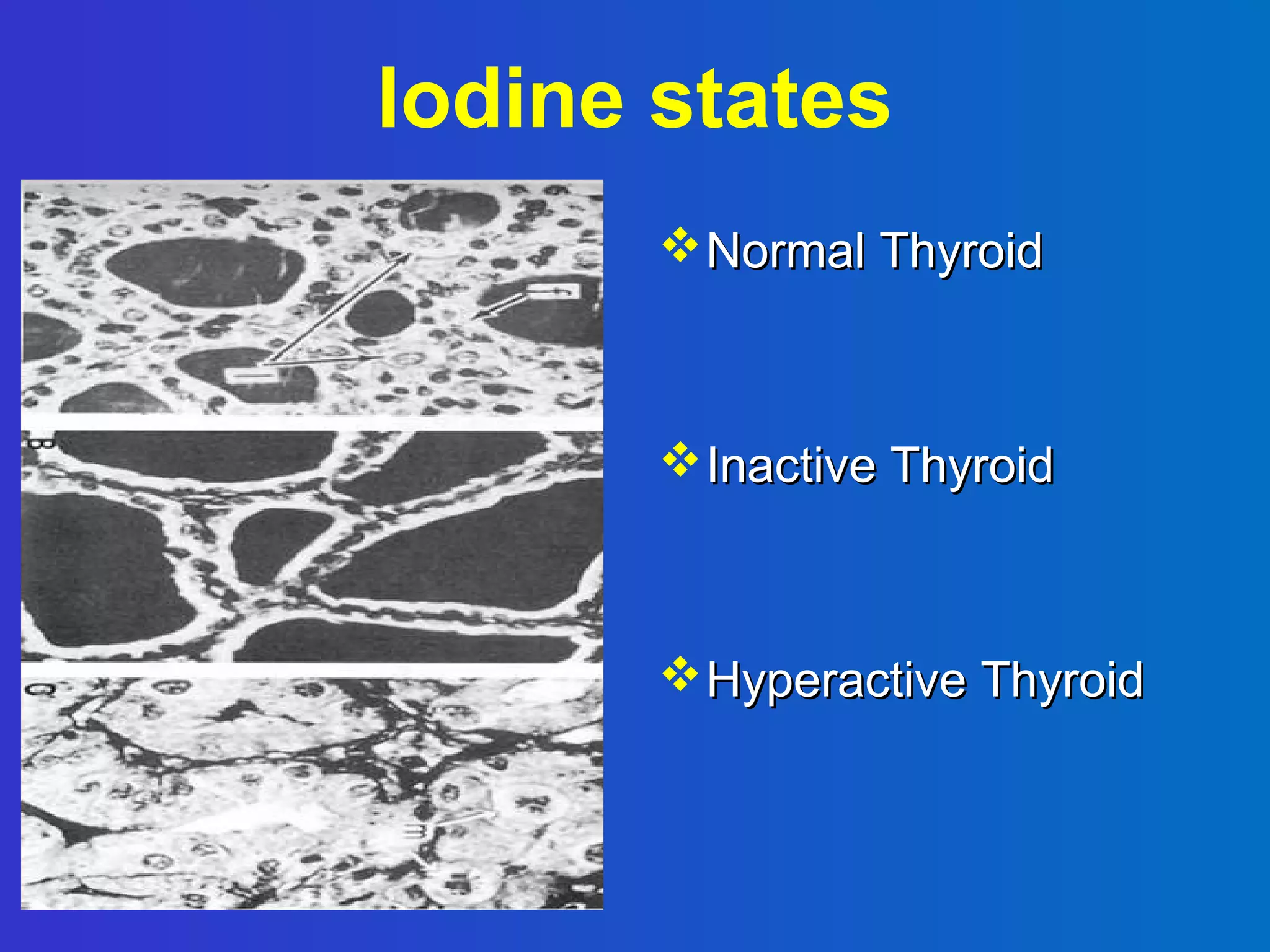 Goiter | PPT