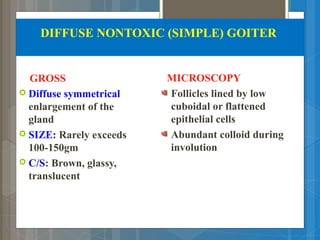 Goiter | PPT