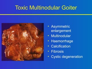 Goiter | PPT