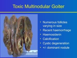 Goiter | PPT