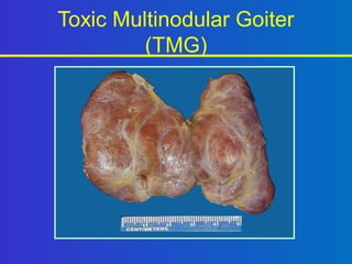 Goiter | PPT