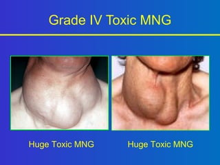 Goiter | PPT