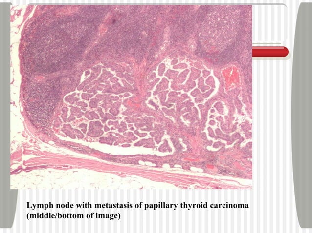Thyroid Tumor Ppt