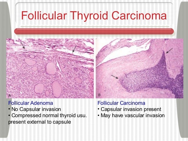 Follicular Carcinoma Capsular Invasion