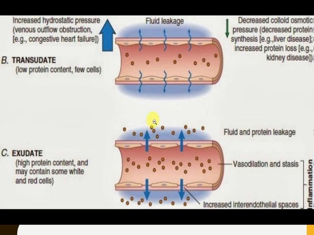Lect-6Serous body fluid.pptx | Lung and Respiratory Health | Diseases ...