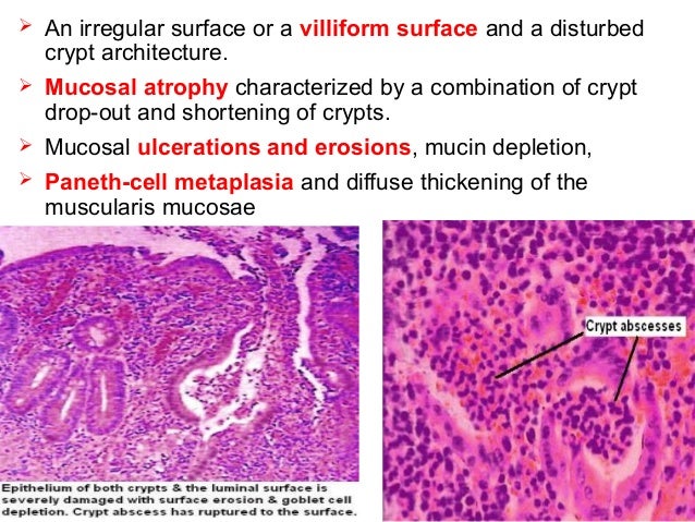 inflammatory bowel disease