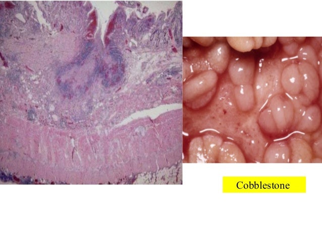 inflammatory bowel disease