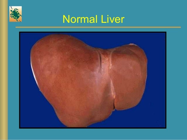 Liver disease