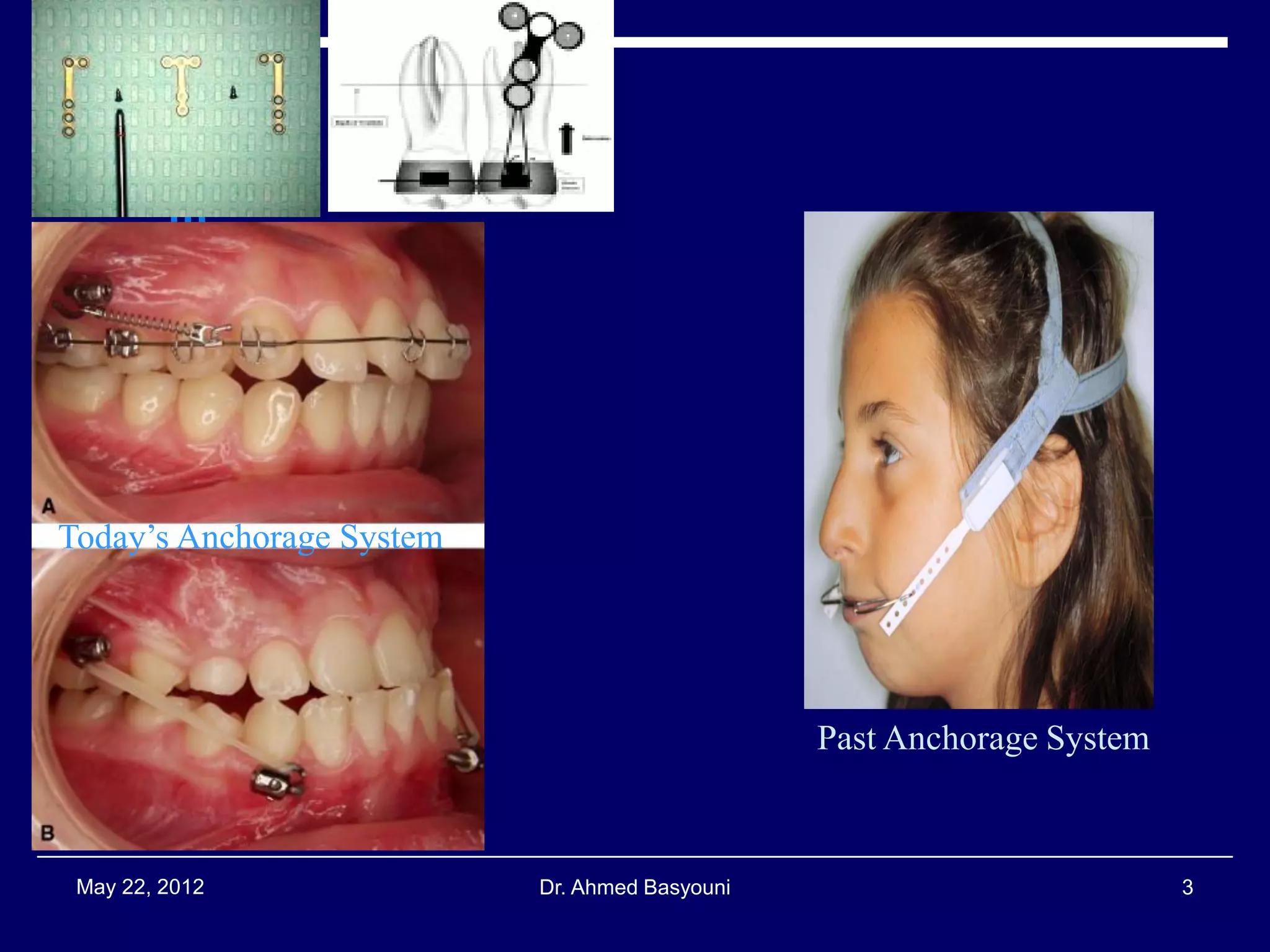 Anchorage in Orthodontics | PDF