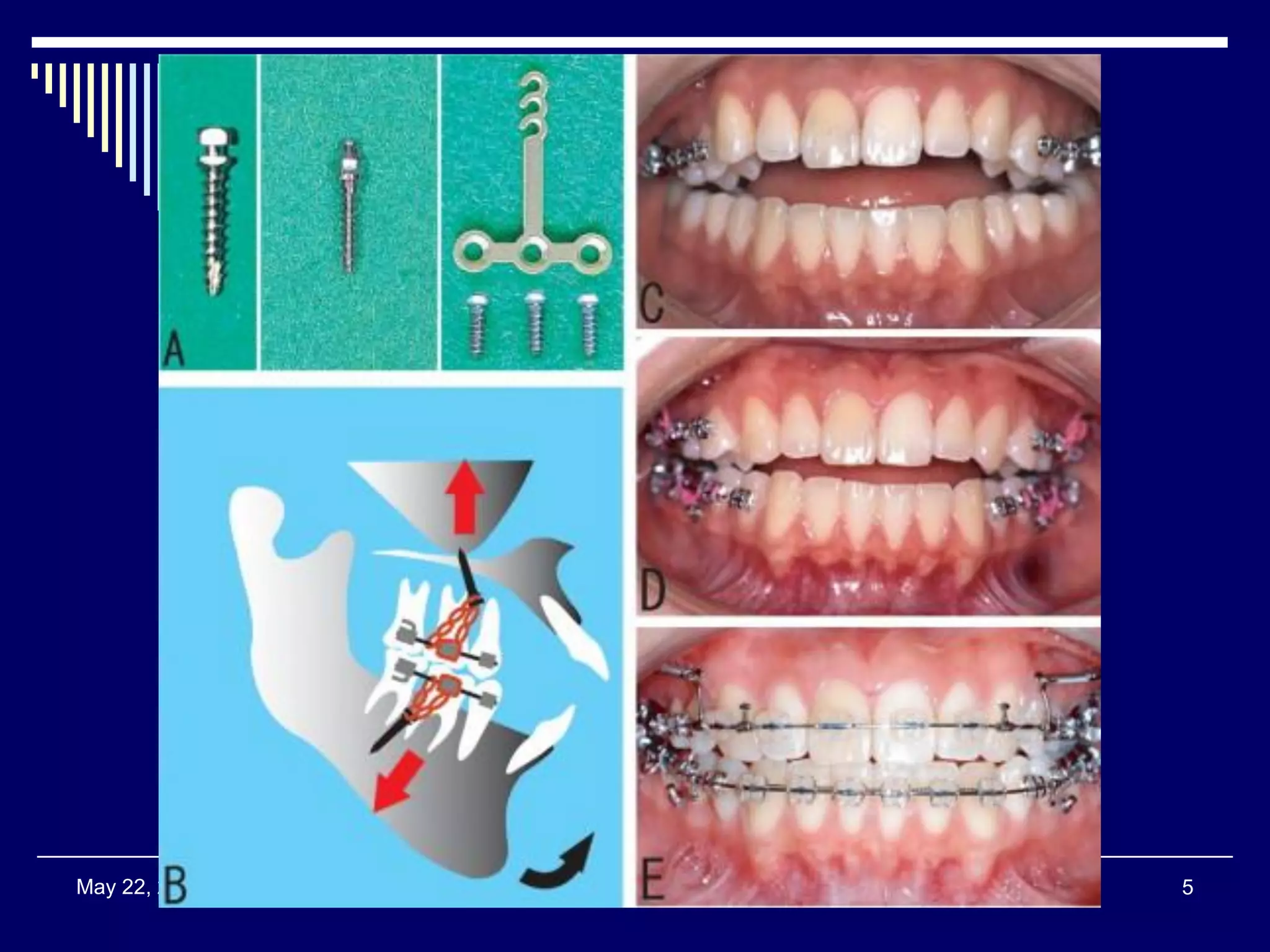 Anchorage in Orthodontics | PDF