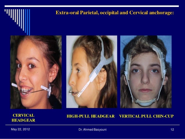 Anchorage in Orthodontics